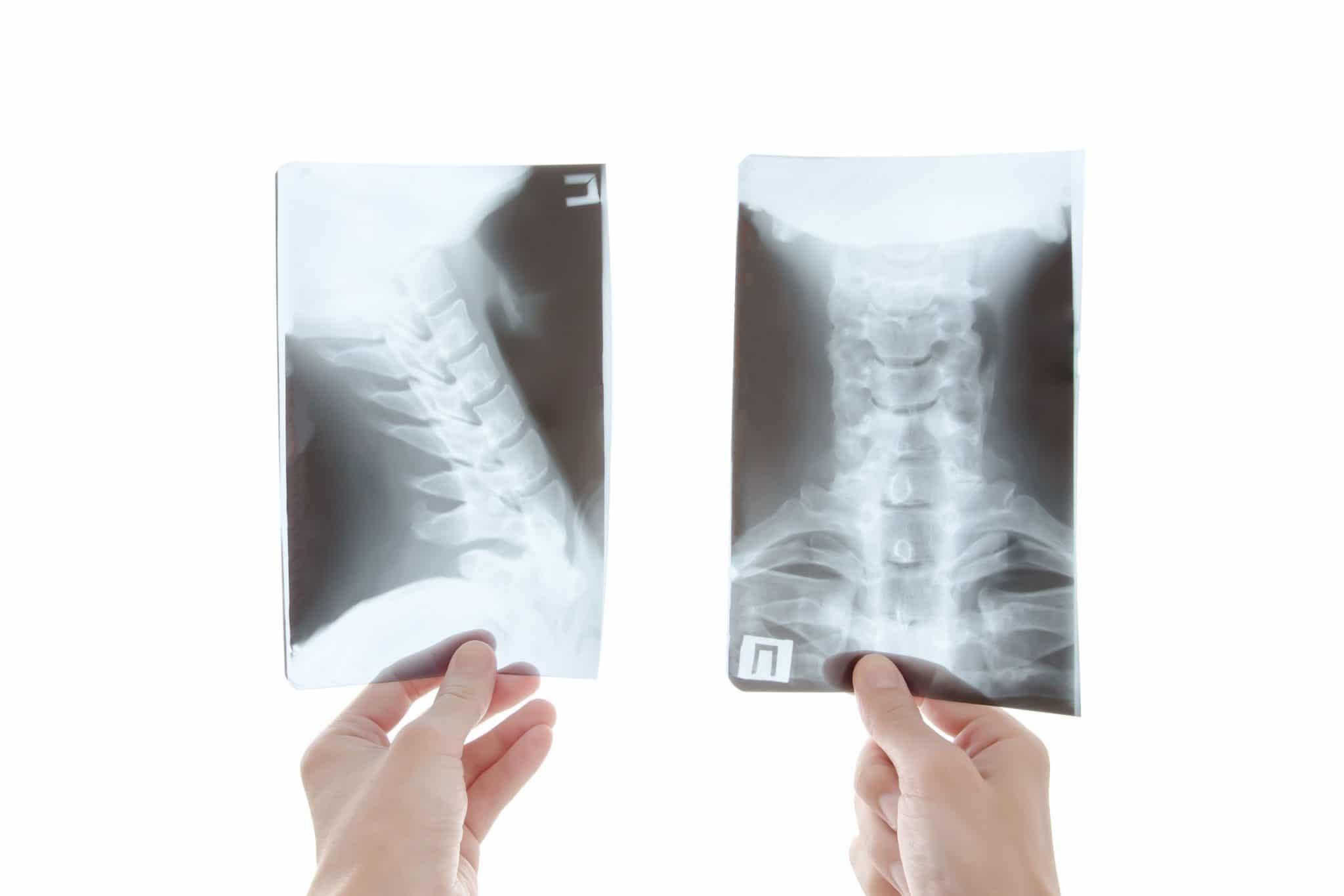 The Importance Of The Cervical Curve Snapcrack Blog Article